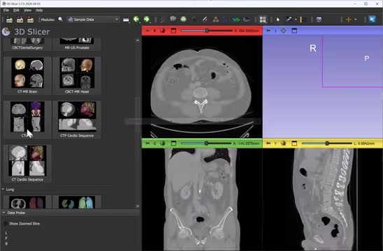 3D Slicer & MONAI: Fast Medical Image Segmentation Guide