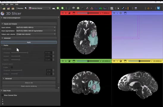 3D Slicer & MONAI: Fast Medical Image Segmentation Guide